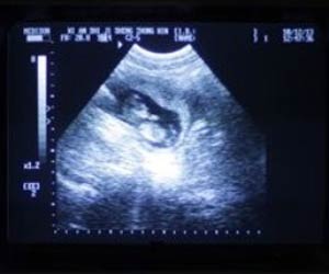 Birth defects more common in IVF babies: study - DAWN.COM