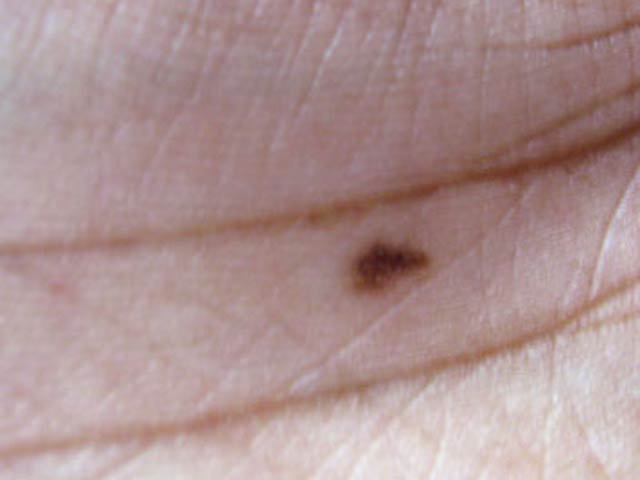 Skin cancer on the rise among young adults - DAWN.COM