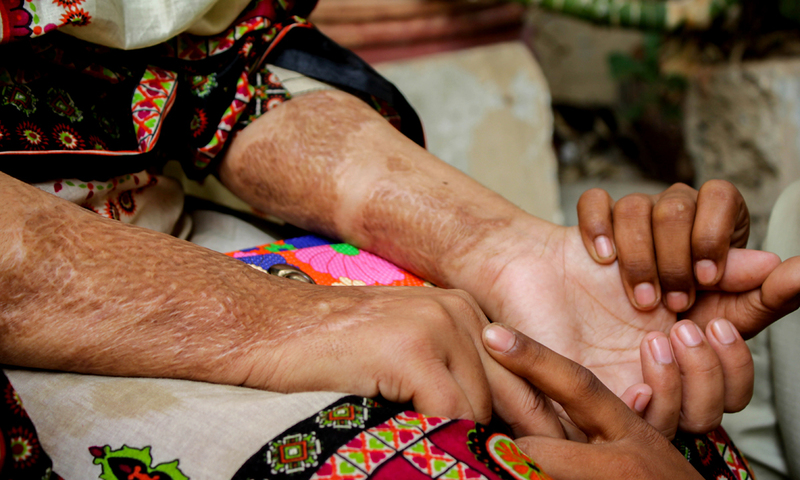 Acid attack - DAWN.COM