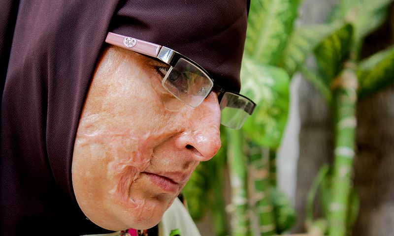 Unforgiving scar: 2014, a year of horrific acid attacks - Pakistan ...