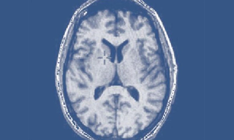 ‘Over two million suffer from epilepsy in Pakistan’ - Pakistan - DAWN.COM