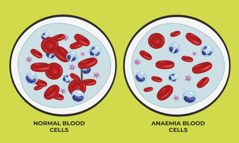 HEALTH: WHY ARE PAKISTANI CHILDREN SO ANAEMIC? - Newspaper - DAWN.COM